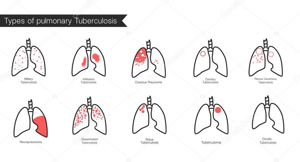 Types of tuberculosis. Vector silhouette medical illustration of human ...