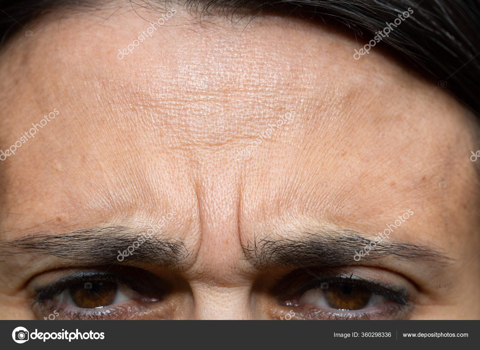 Furrowed Brow Wrinkles