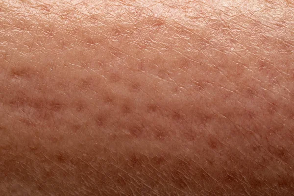 Dry skin texture Stock Photo by ©panxunbin 6918503