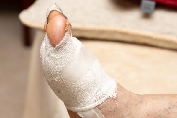 Metatarsal fracture of the foot. Protective bandage for the healing ...