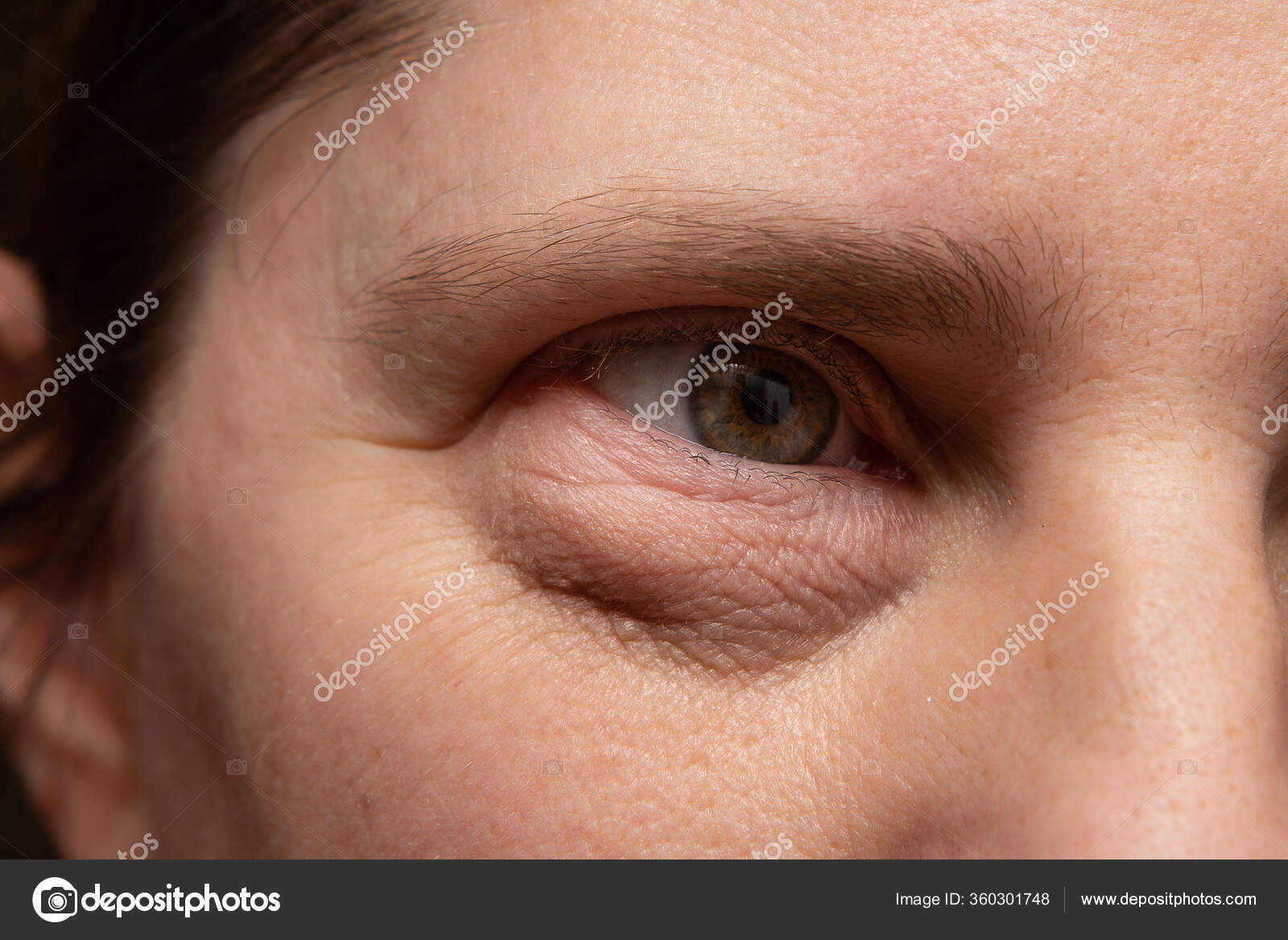 Macro Swelling Lower Eyelid Commonly Called Bag Eye — Stock Photo ...