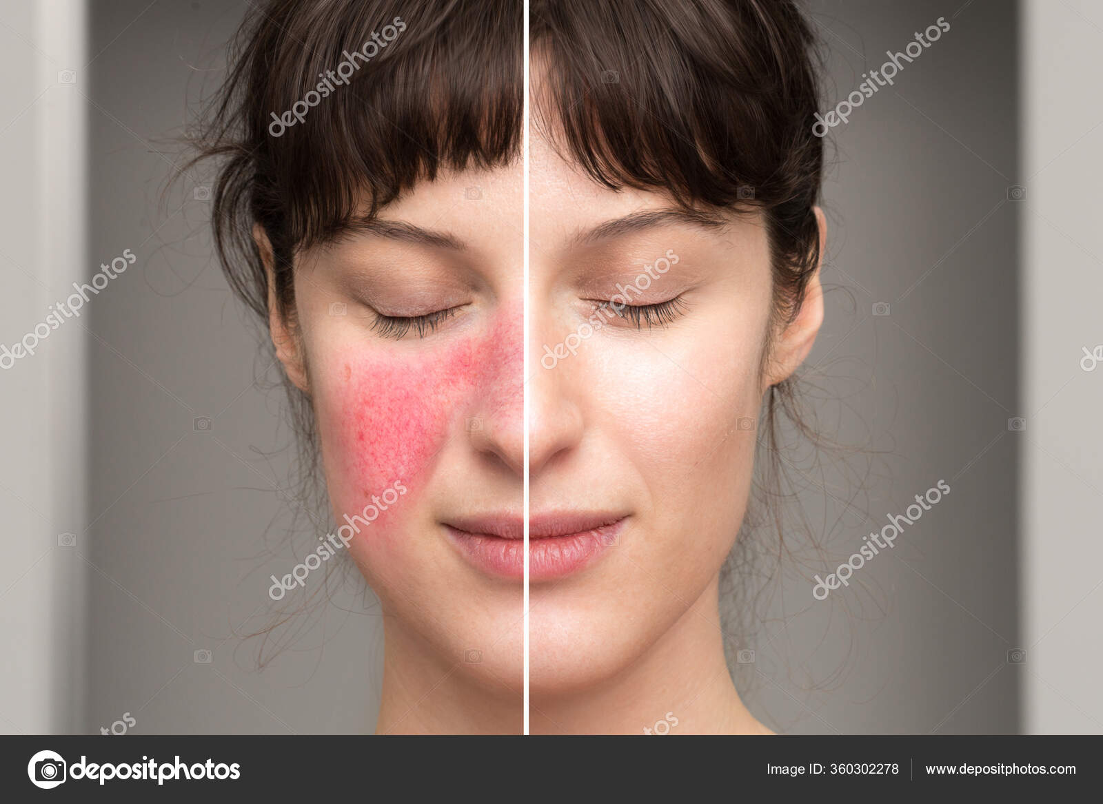 Rosacea Treatment Natural