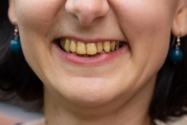 Yellow teeth Images - Search Images on Everypixel