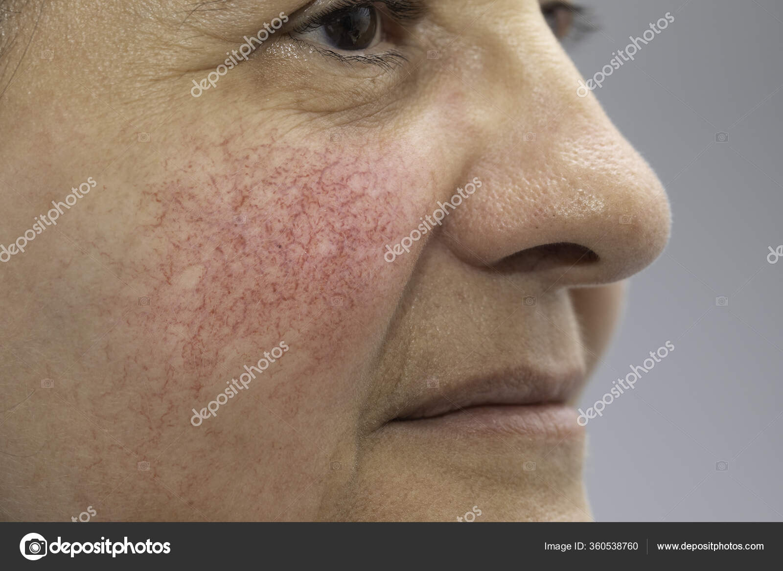 What Are Red Cheeks A Symptom Of