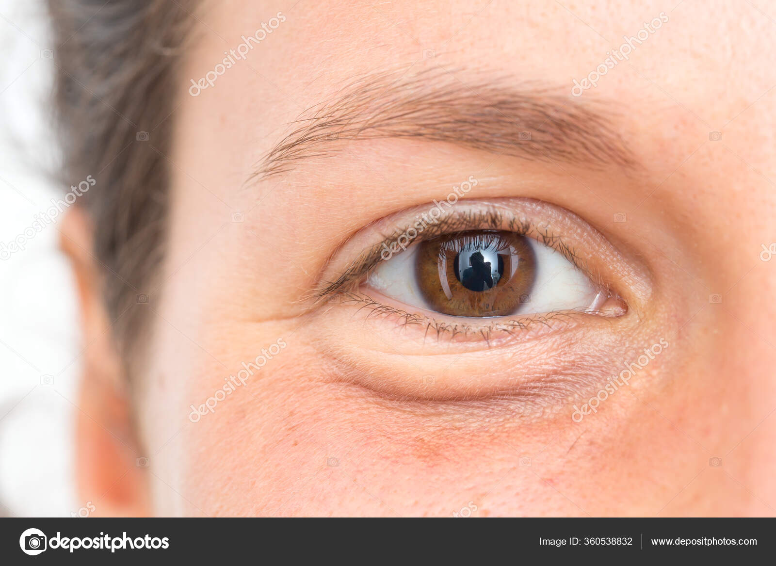 Visão Perto Sobre Olho Inchado Inchado Uma Fêmea Causando Saco — Foto ...
