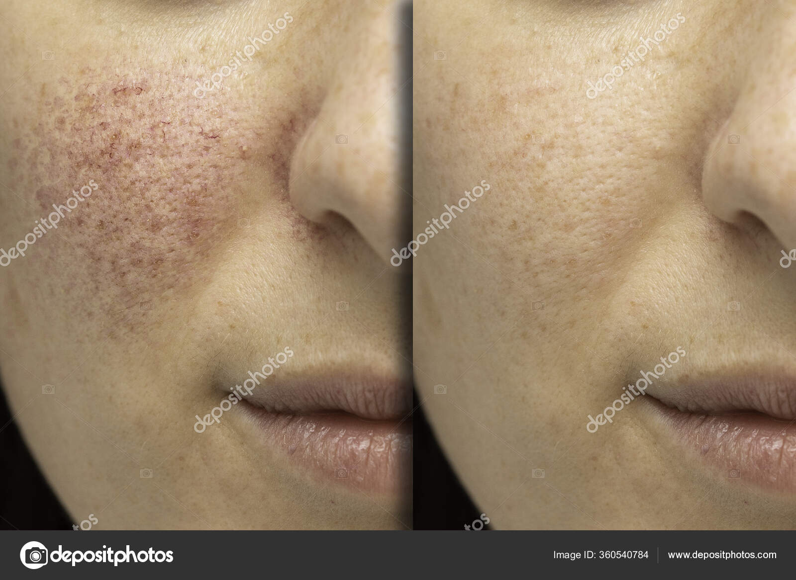 Före Och Efter Behandling För Avlägsnande Rosacea Ansiktet ...