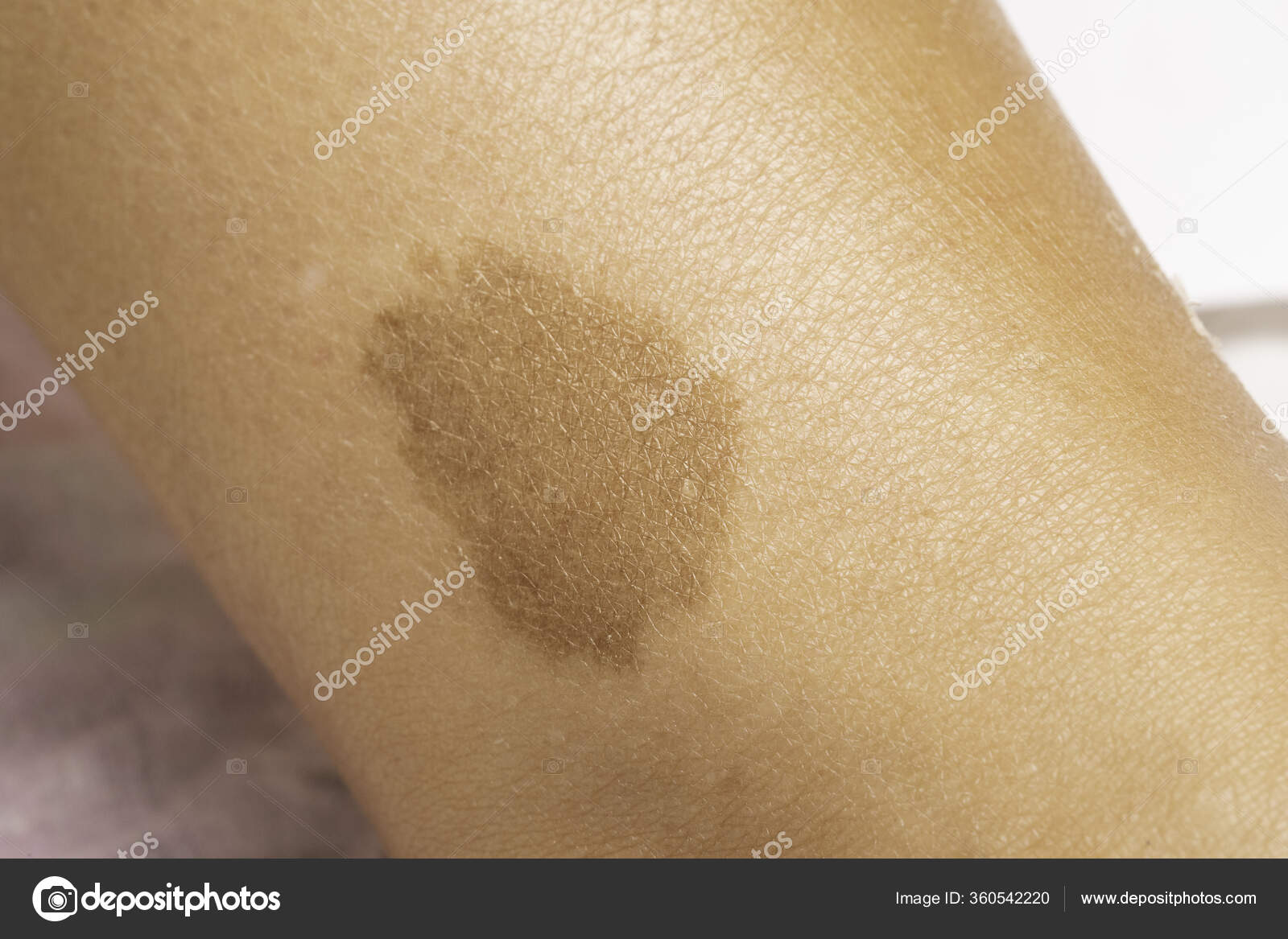 Brown Birthmark On Leg
