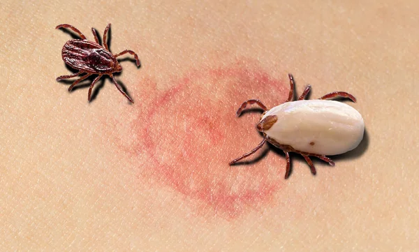 Morsure de tique symptomes images libres de droit, photos de Morsure de ...