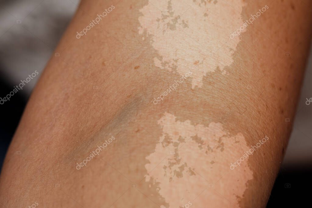 Una vista de cerca en el brazo de una persona que sufre de tiña ...