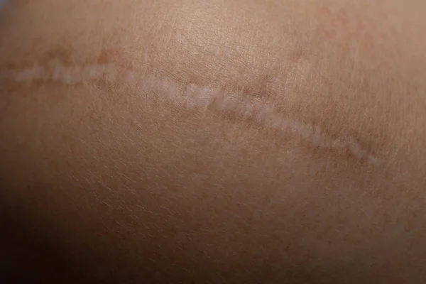 Keloid Stock Photos, Royalty Free Keloid Images | Depositphotos®