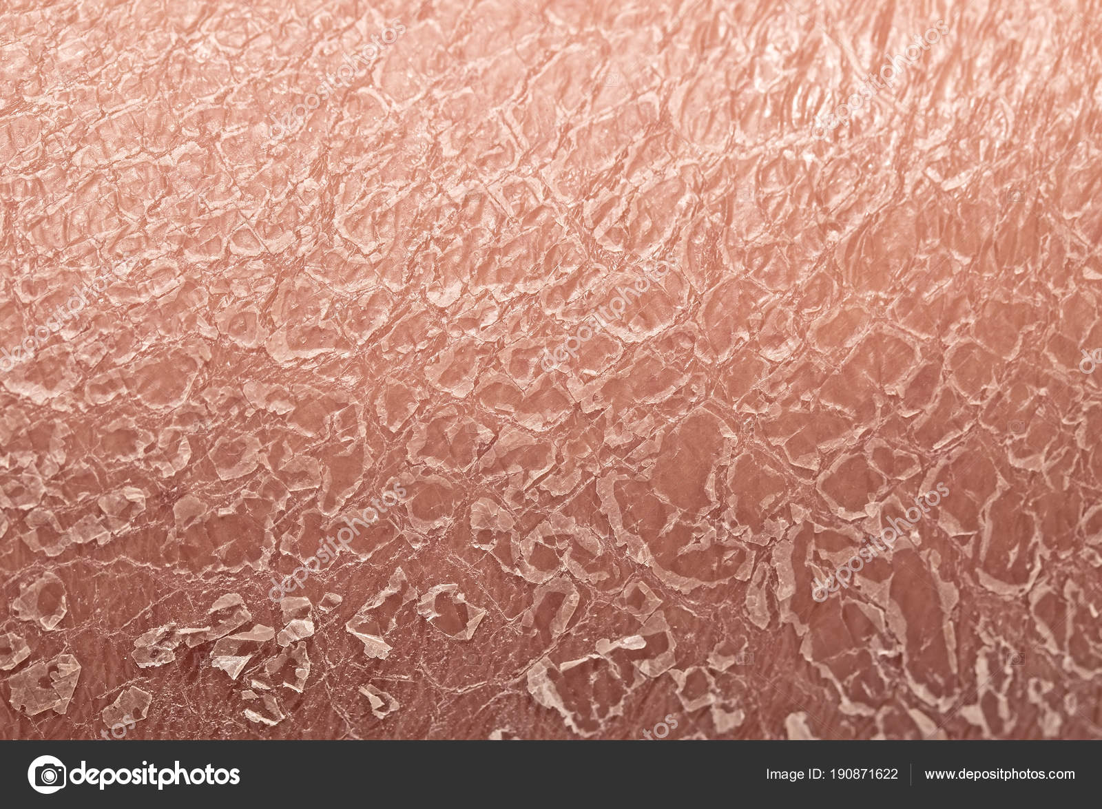 Texture of the unhealthy human skin epidermis with flaky and cr — Stock ...