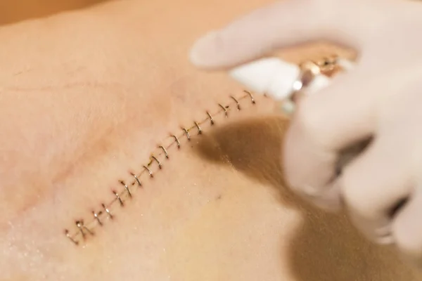 A wound on the skin — Stock Photo © CatherineL-Prod #141140278