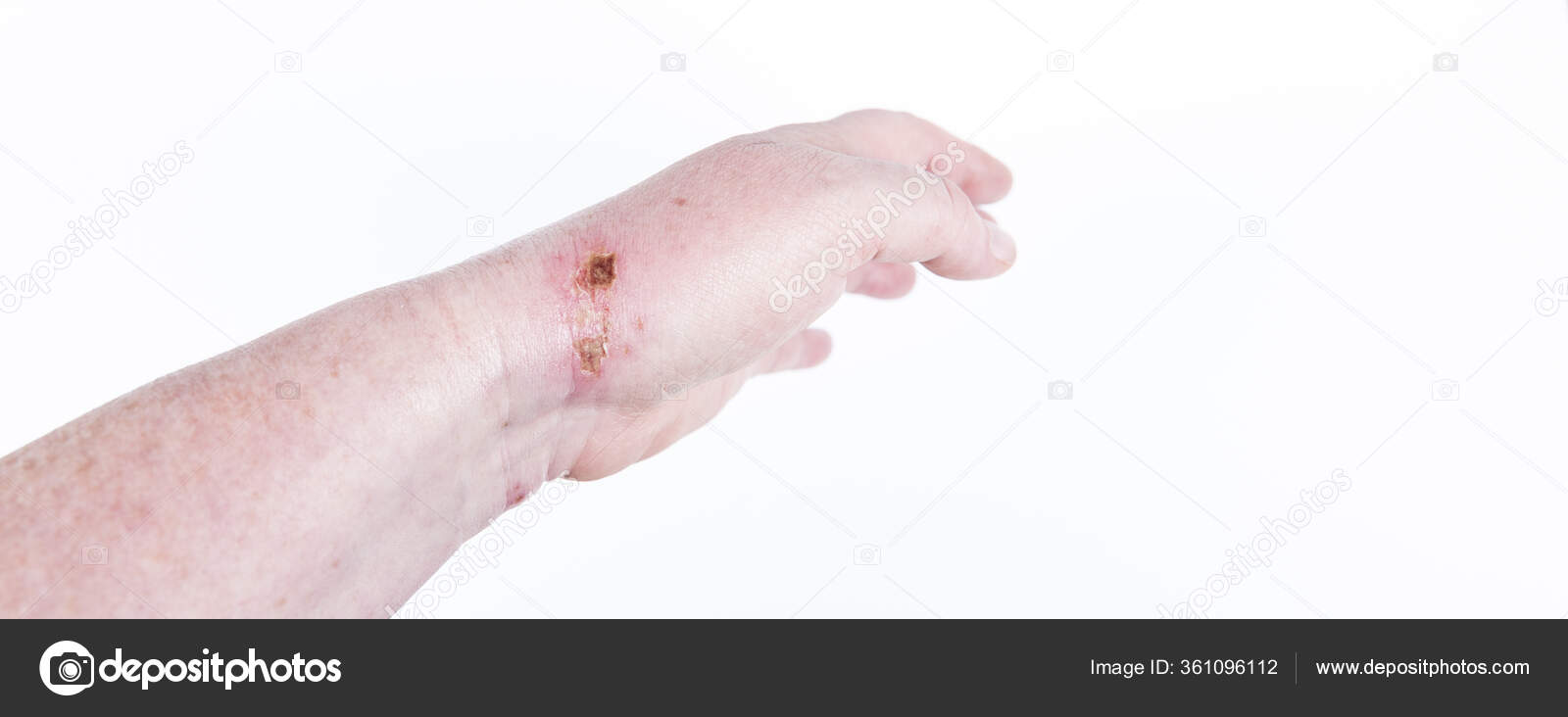 Chemical Burn Wrist Skin Hydroxide Sodium Acid Striping Paint Wood ...