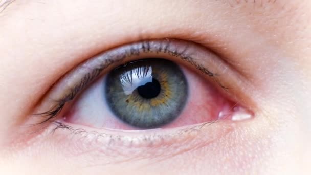 Gros plan d'un œil rouge sanguin sévère. Blepharite virale ...