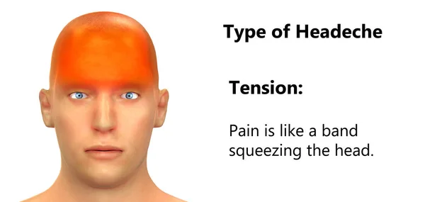 Human Headache Types Anatomy Cluster Illustration — Stock Photo ...
