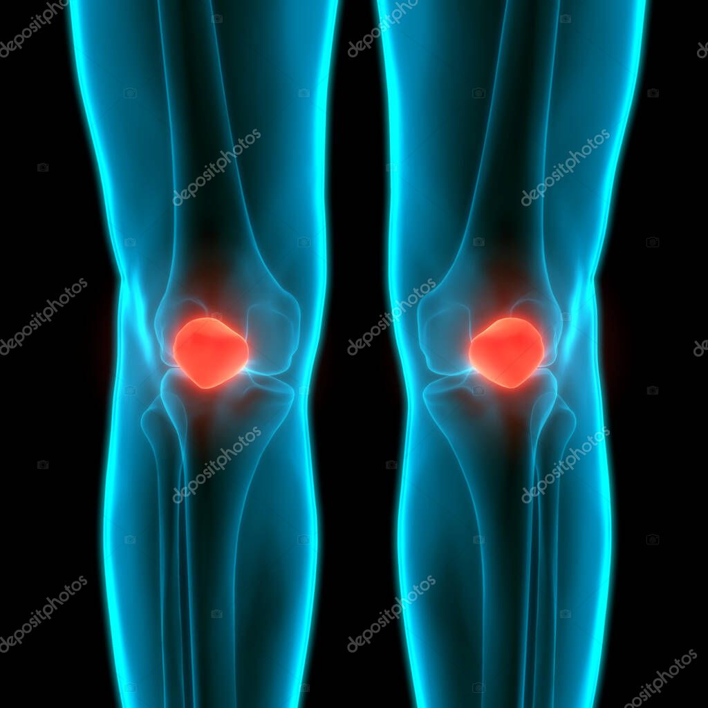 Dolores en las articulaciones óseas del cuerpo humano (huesos de la ...