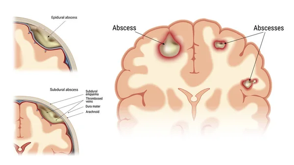 36 Abcessen Vector Images | Depositphotos