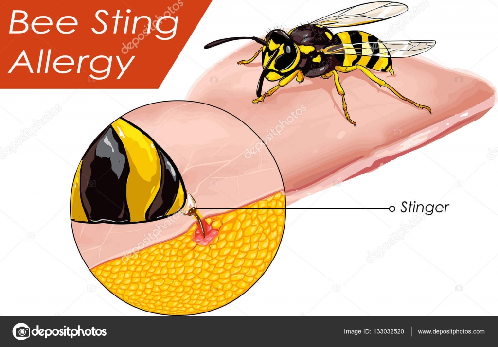 Vector illustration of a Bee sting allergy Stock Vector by ...