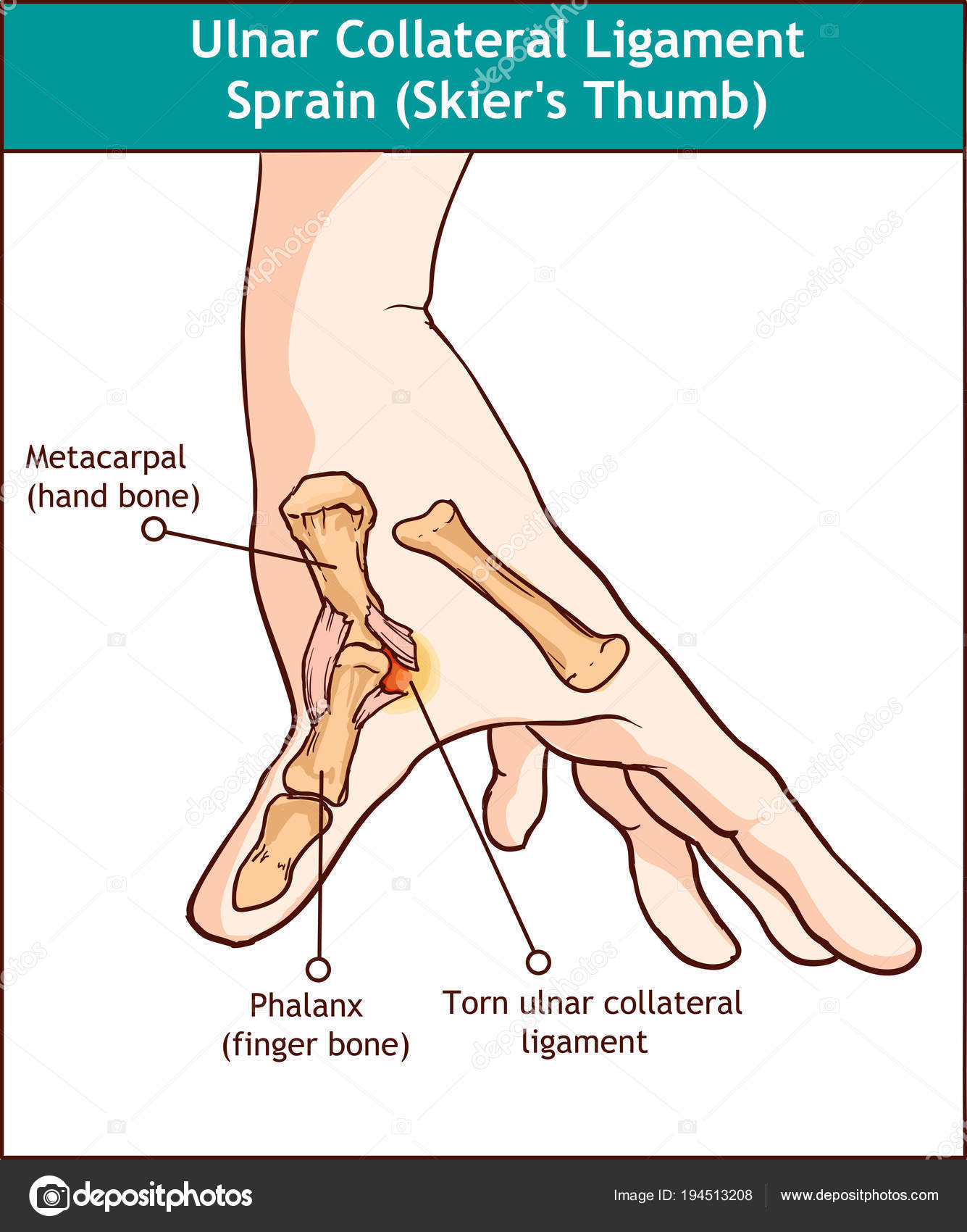 Collateral Ligament Hand