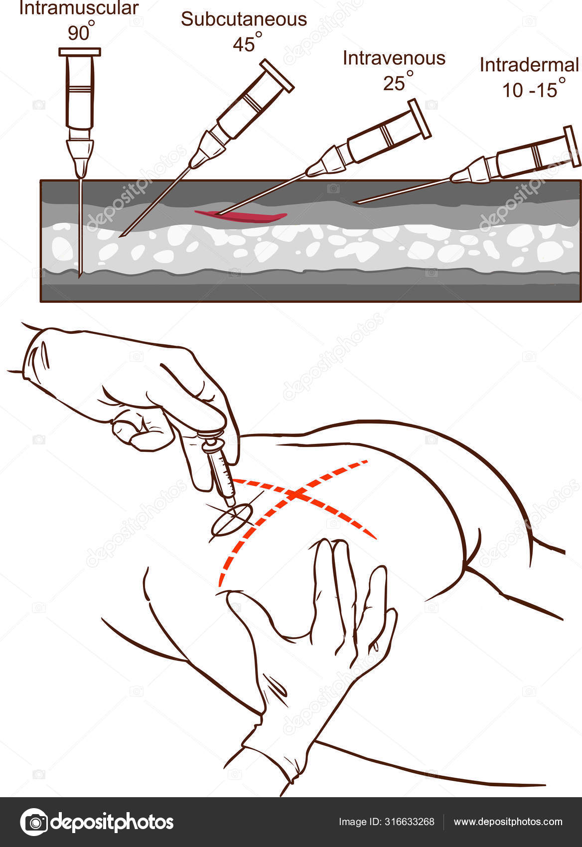 Illustration Vectorielle Injection Intramusculaire Comparaison Des ... Illustration Vectorielle Injection Intramusculaire Comparaison Des ...