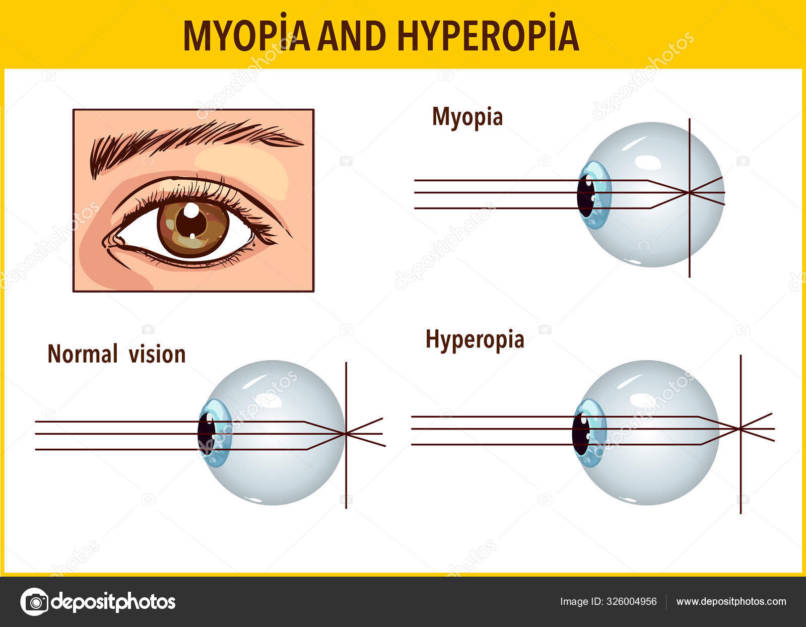 Defeitos oculares humanos ópticos. Miopia e hipermetropia. Estru ...