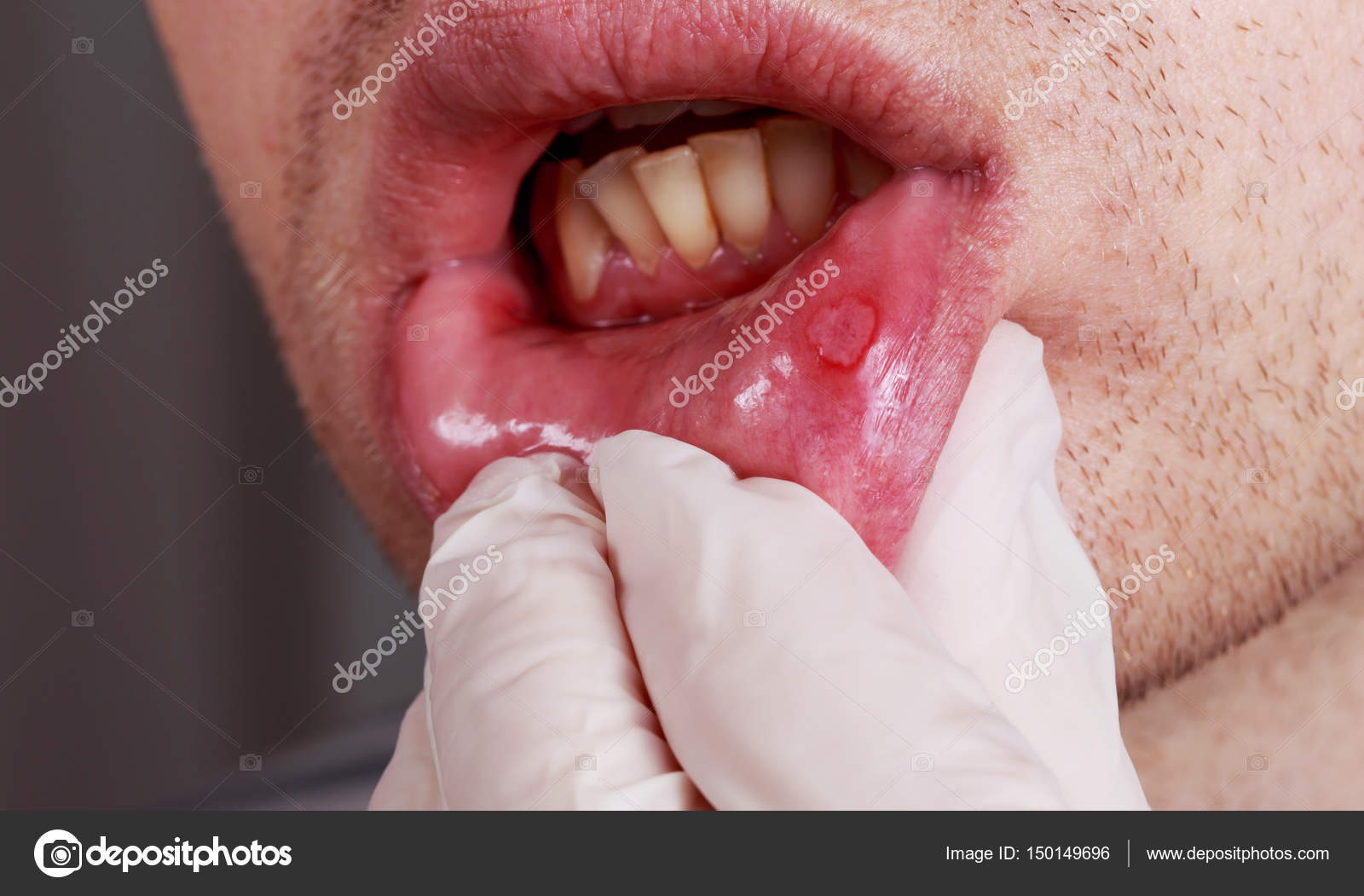 Stomatitis Lips