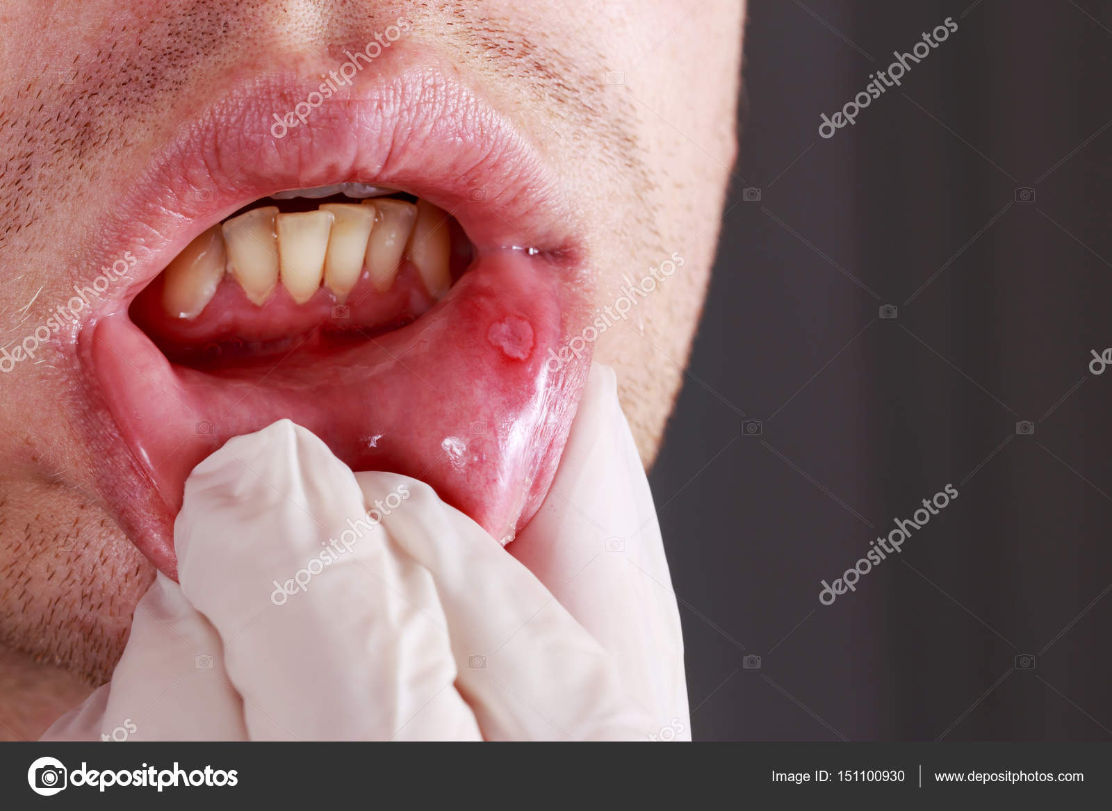 Stomatitis on the lips Stock Photo by ©DevidDO 151100930