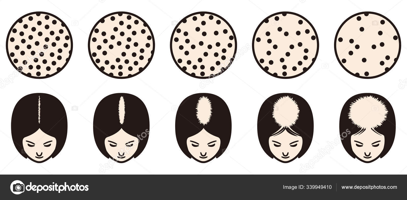 Aggregate More Than 138 Ludwig Pattern Hair Loss Latest Vn