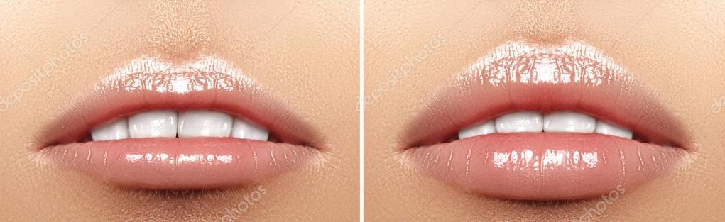 Antes y después de las inyecciones de relleno de labios. Plástico de ...