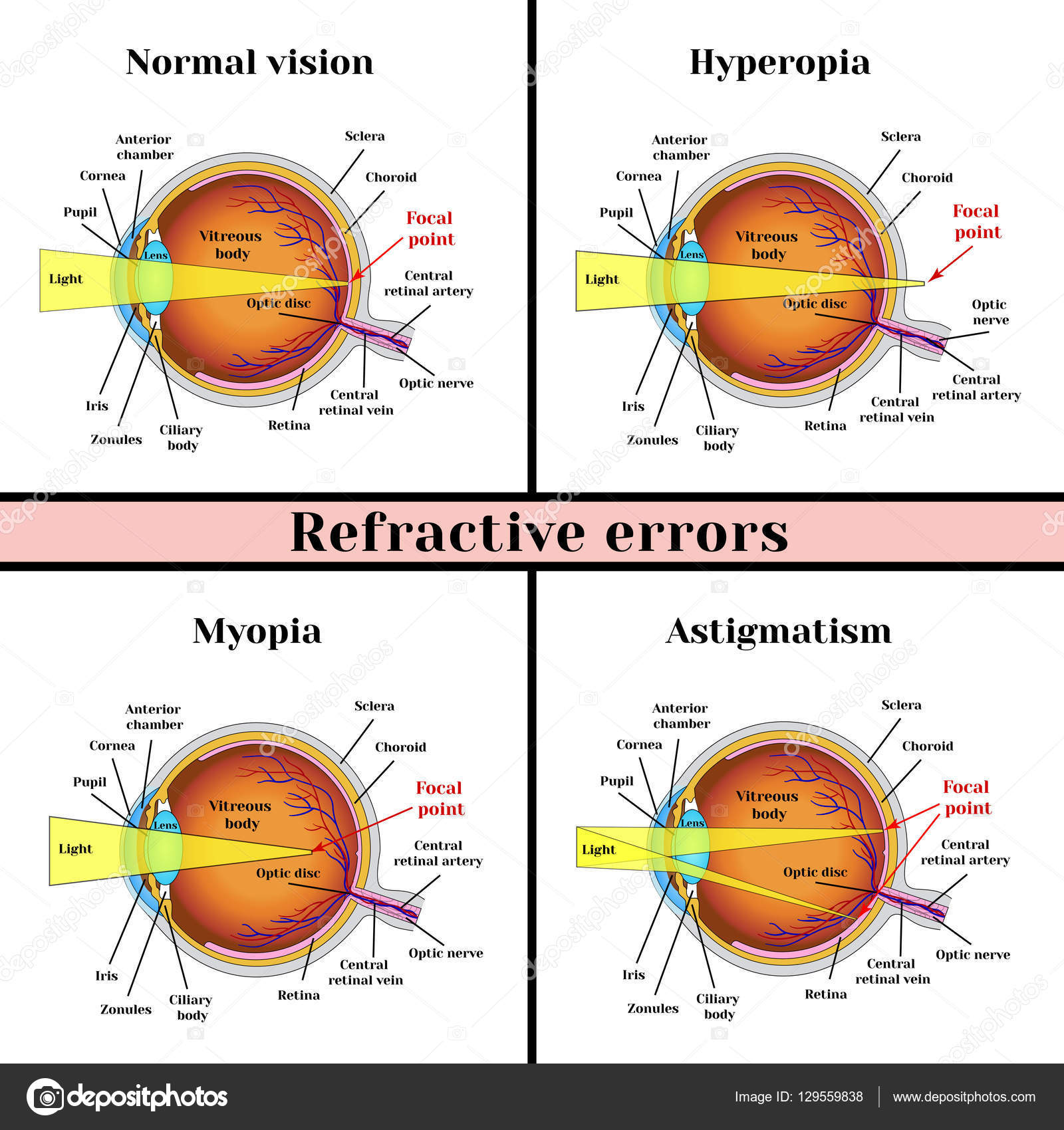 Myopia Hyperopia Astigmatism
