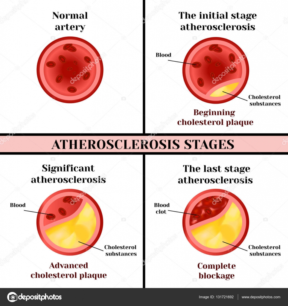 Atherosclerosis stages. Cholesterol plaques. Stock Vector by ©mrs ... Atherosclerosis stages. Cholesterol plaques. Stock Vector by ©mrs ...