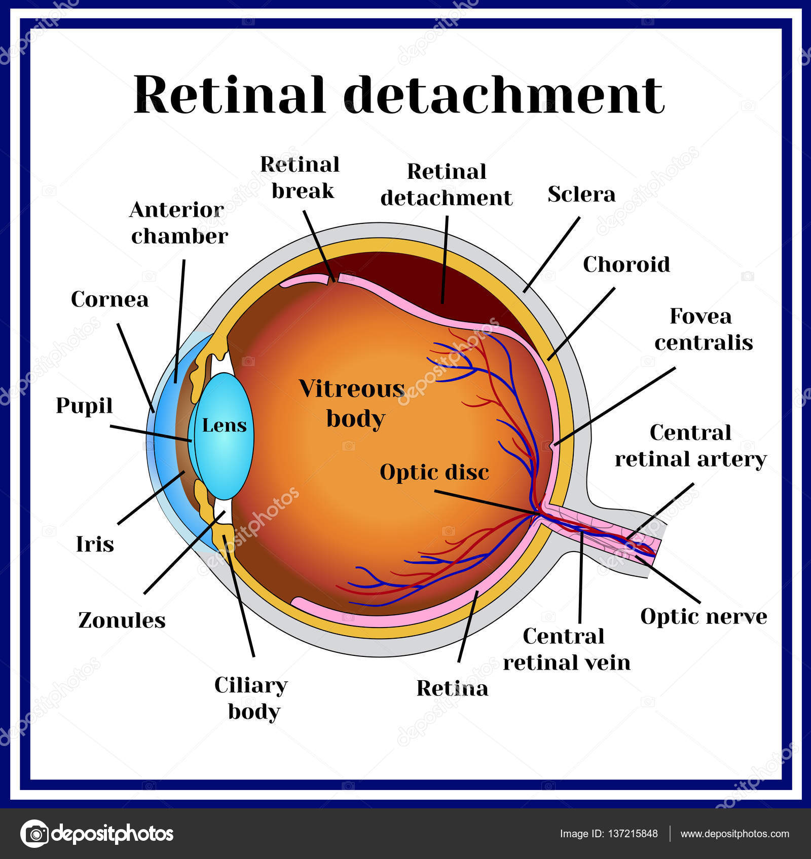 Retinal detachment. Disease. Stock Vector Image by ©mrs.bazilio.gmail ...