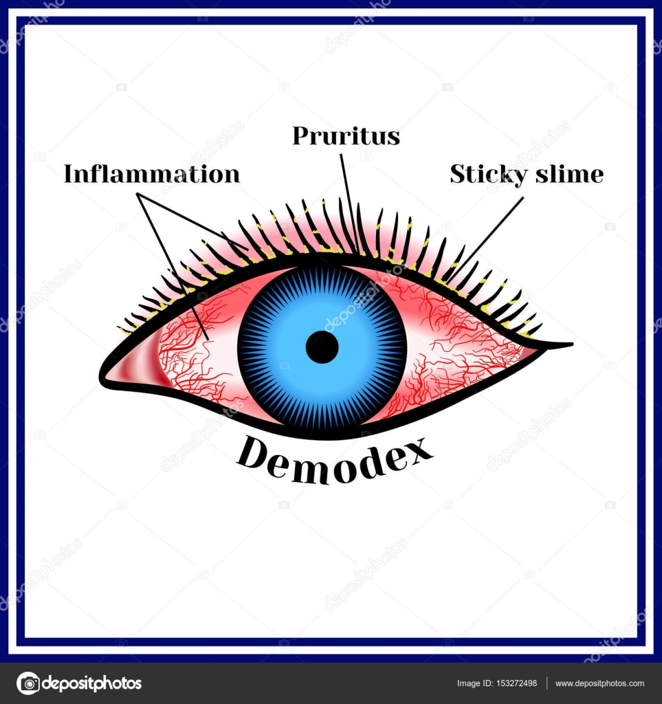 Demodex. Parasitic eye disease. Stock Vector by ©mrs.bazilio.gmail.com ...