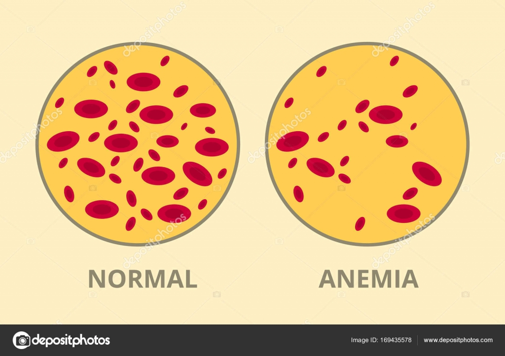 Compare between normal blood cell vs anemia disease sick Stock Vector ...