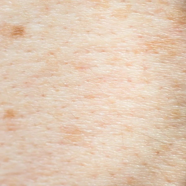 Shingles skin Stock Photos, Royalty Free Shingles skin Images ...