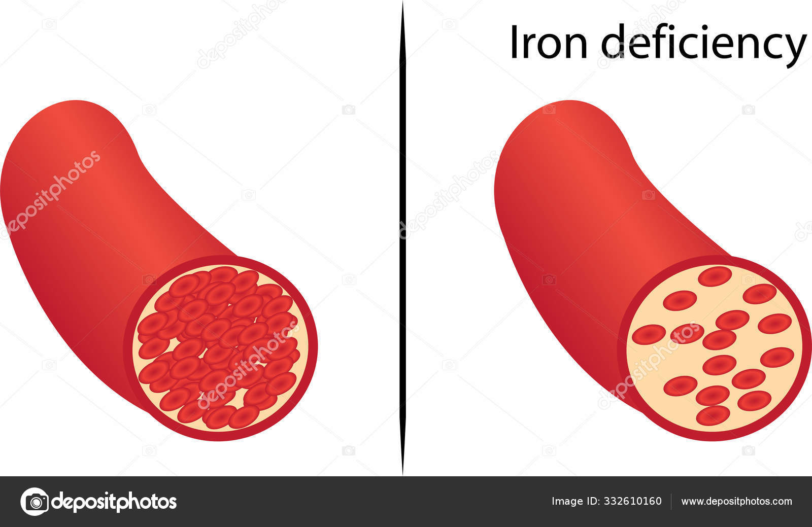 Chronic Iron Deficiency Yellow Skin Vector Illustration Stock Vector ...
