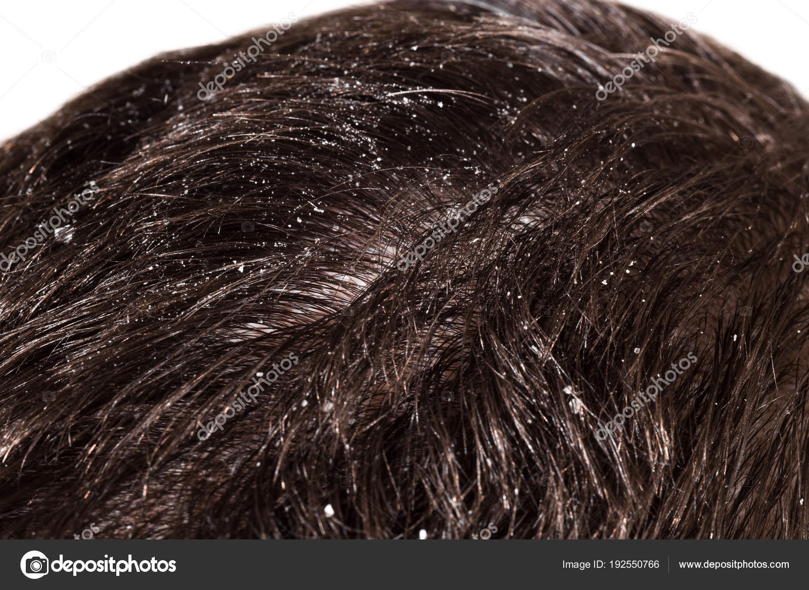 Dandruff on male dark hair Stock Photo by ©1odinmig.gmail.com 192550766
