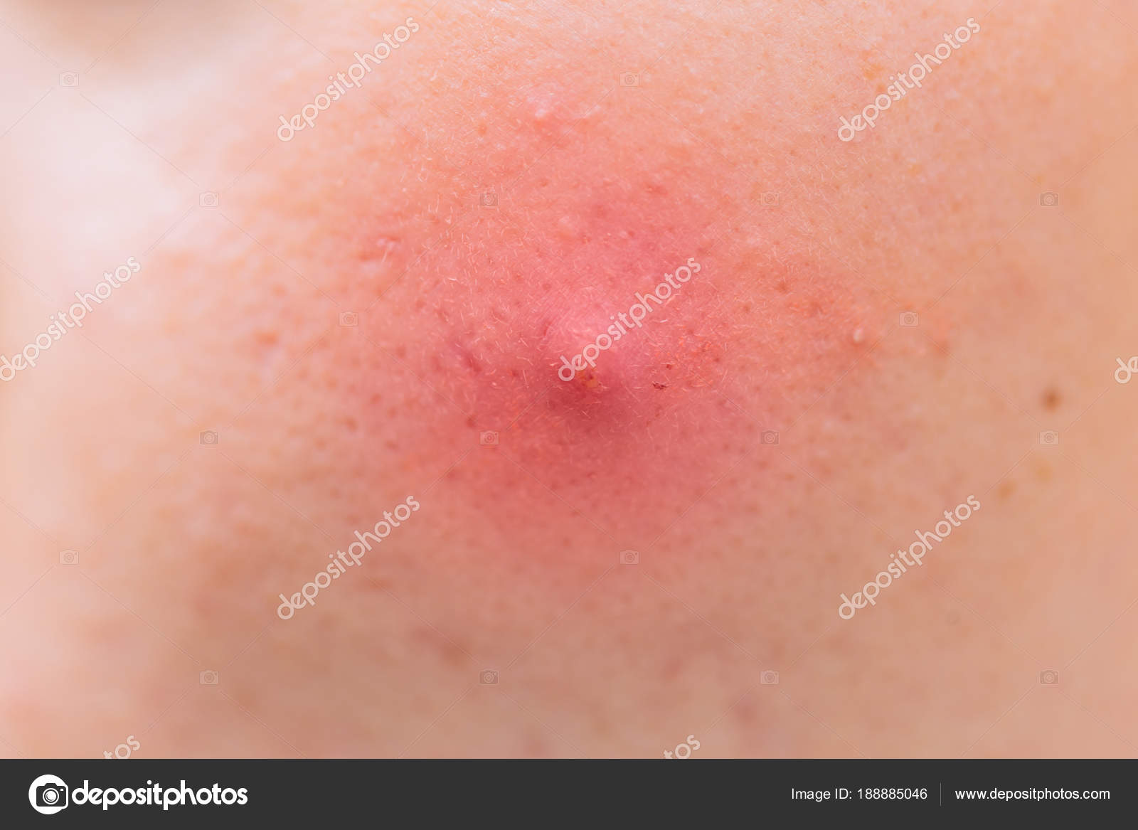 Closeup Big Acne Head Skin Inflammation Problem — Stock Photo ...