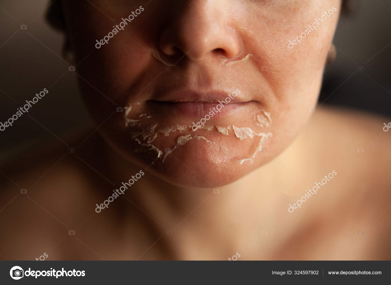 Retinoic face peeling. Woman's face after chemical peeling. Flaky skin ...