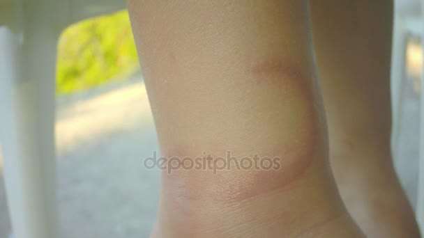 60 Pista de mordida Videos, Royalty-free Stock Pista de mordida Footage ...