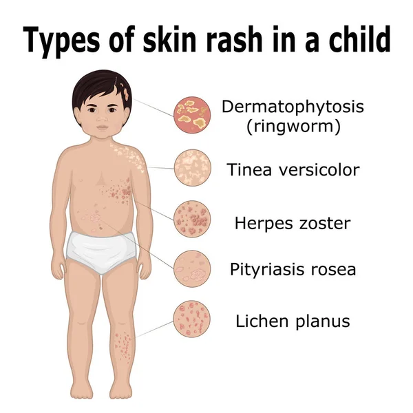Skin rash Stock Vectors, Royalty Free Skin rash Illustrations ...