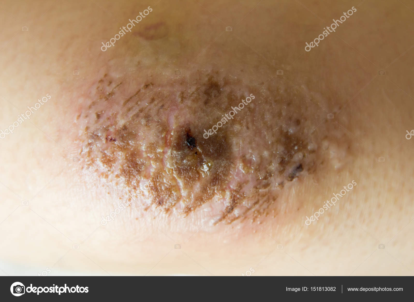 Closed up of red scab injury on woman knee background — Stock Photo ...