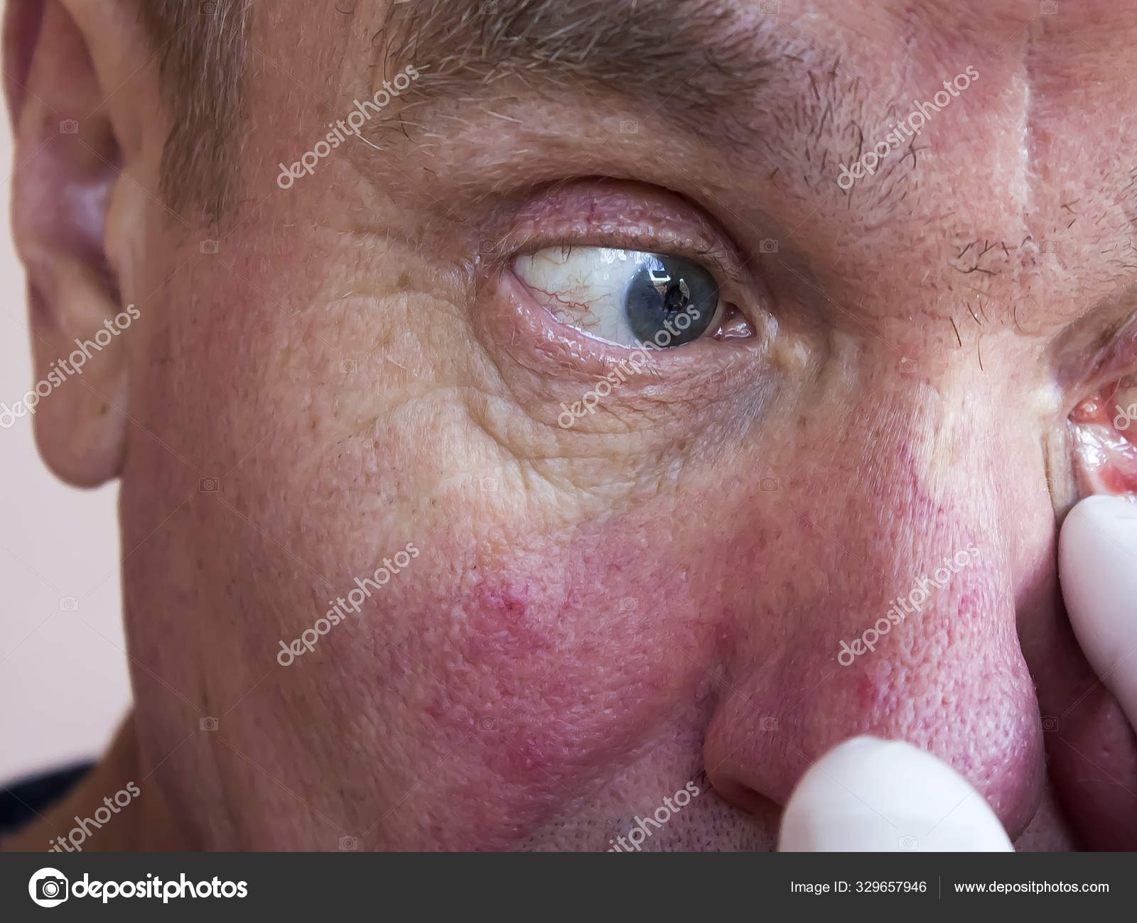 Demodecosis Face Eyes Man Examination Treatment Ophthalmology Skin ...