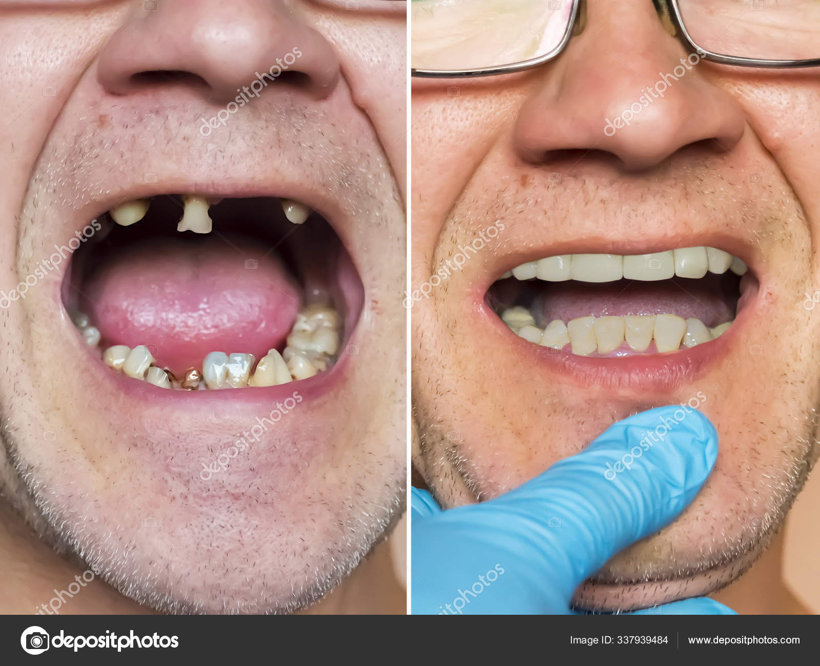 Diseased teeth. Severe rot, caries, tooth loss. A man examined b Stock ...