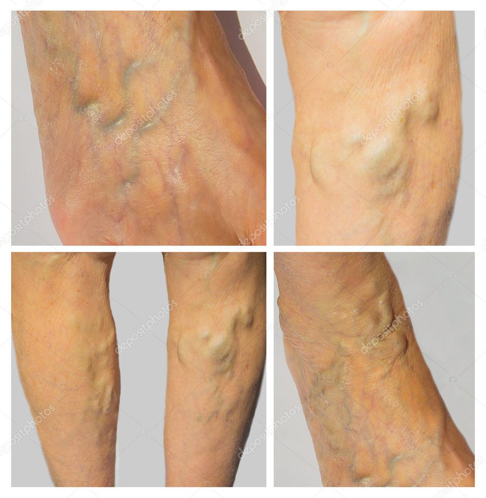 Varicose veins on a female legs — Stock Photo © Marina113 #127816500