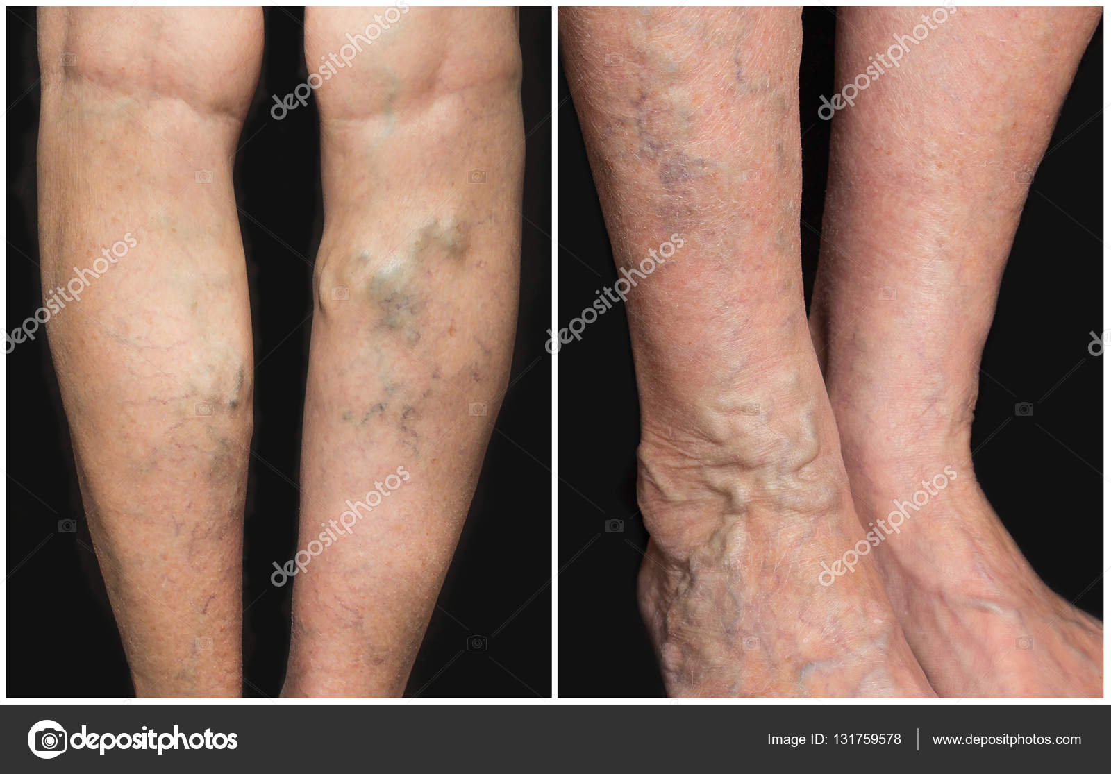 Varicose veins on a female legs Stock Photo by ©Marina113 131759578