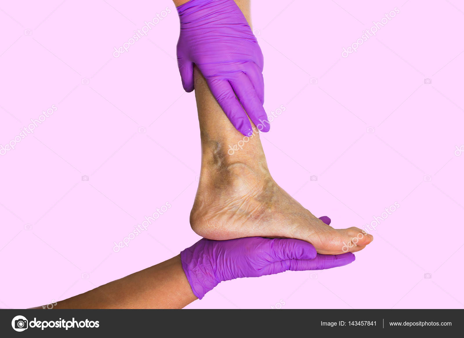 Lower limb vascular examination because suspect of venous insufficiency ...