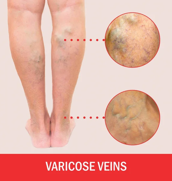 Varicose veins on a female senior leg — Stock Photo © Marina113 #176404962