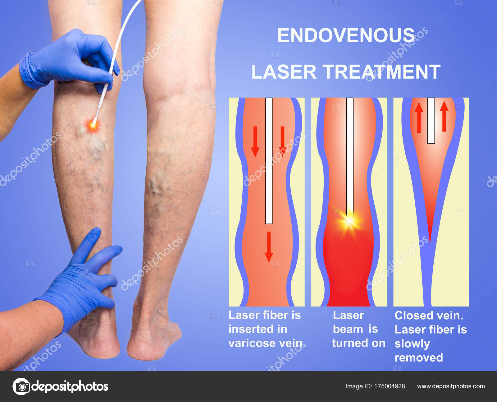 Varicose Veins In Hands
