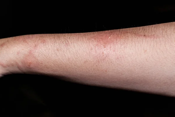 Dog bite wound and scar with dark background Stock Photo by ...